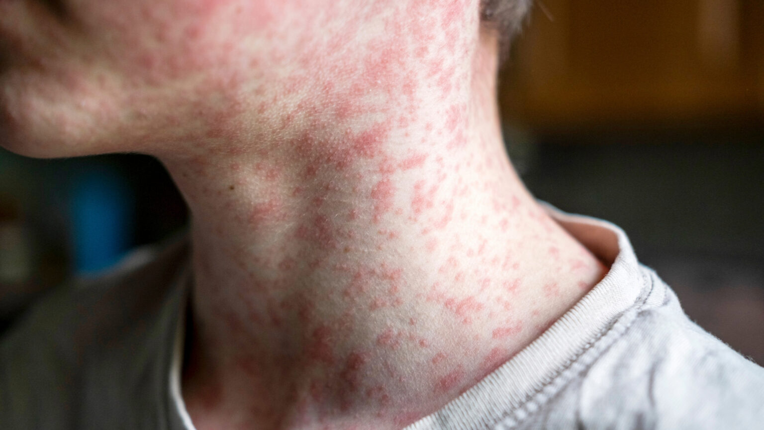 CDC recomienda a todos los viajeros internacionales se vacunen contra ...